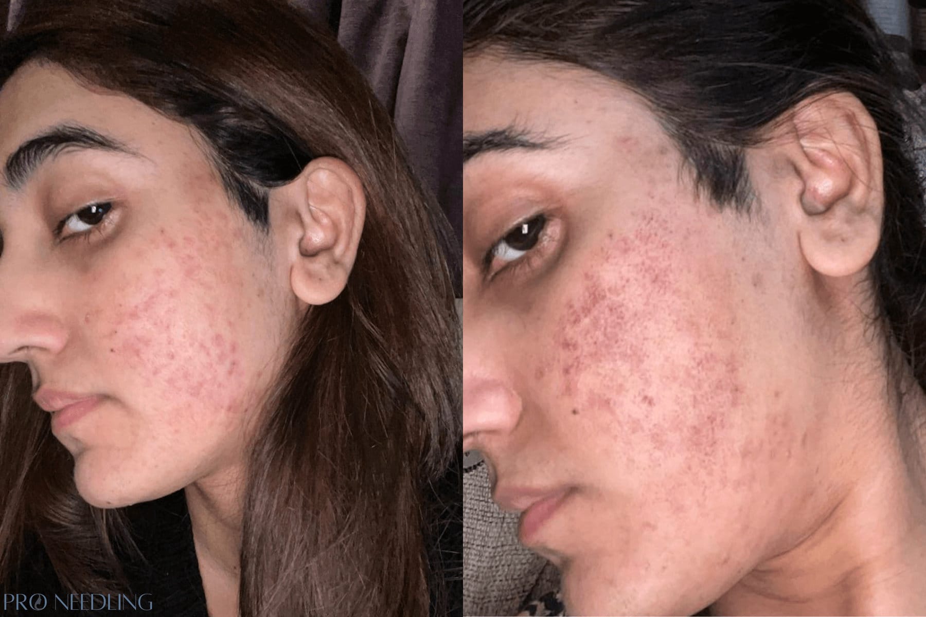 I Tried Microneedling For Acne Scars - Pro Needling